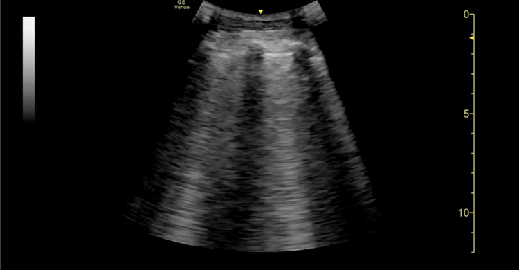 Critical Care Pearls - Sympathetic Crashing Acute Pulmonary Edema ...