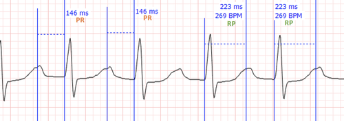Heart of the Matter: SVT and the RP Interval — Cook County Emergency ...