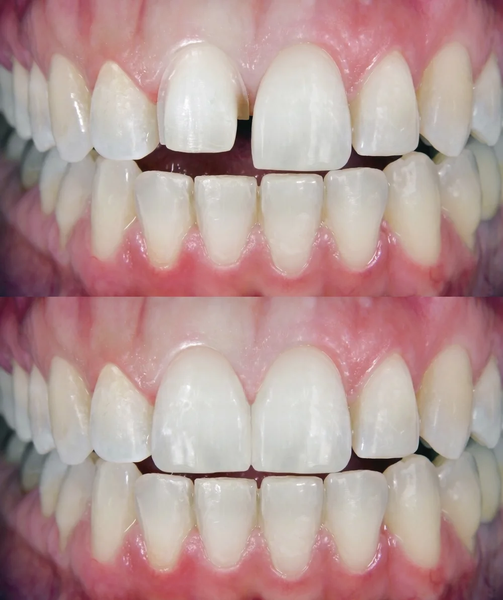 Veneers — MAS’OOD CAJEE, DDS, MPH