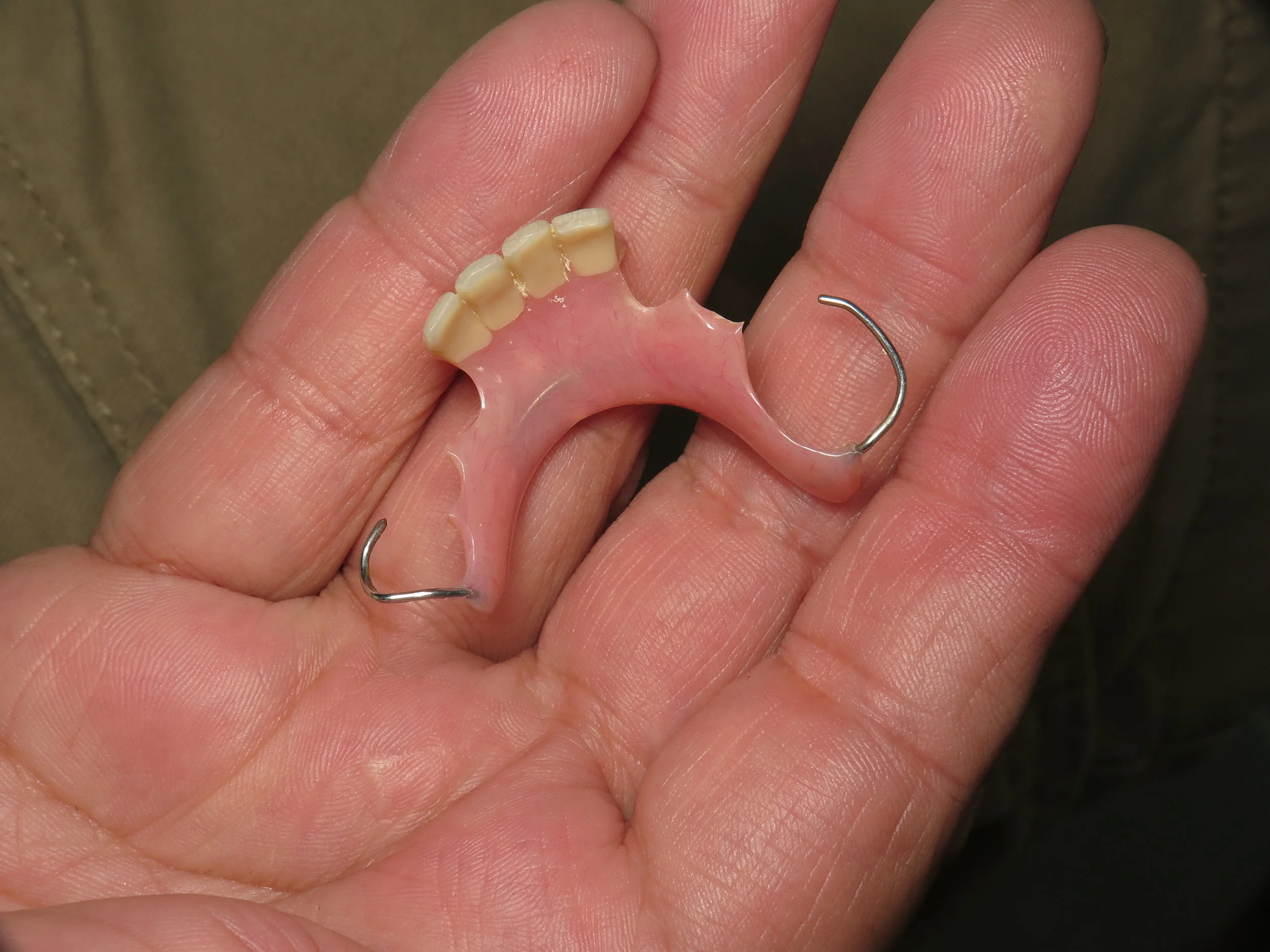 Dentures — MAS’OOD CAJEE, DDS, MPH