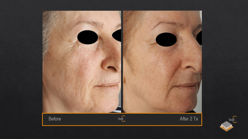 Rejuvenate Your Skin with Tixel: Non-Invasive Anti-Aging Treatments in ...