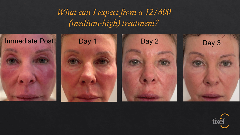 Rejuvenate Your Skin with Tixel: Non-Invasive Anti-Aging Treatments in ...