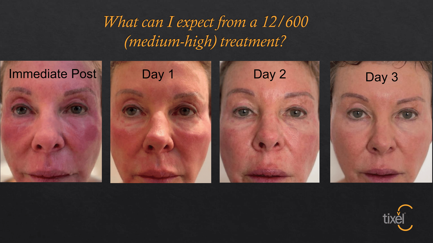 Rejuvenate Your Skin with Tixel: Non-Invasive Anti-Aging Treatments in ...