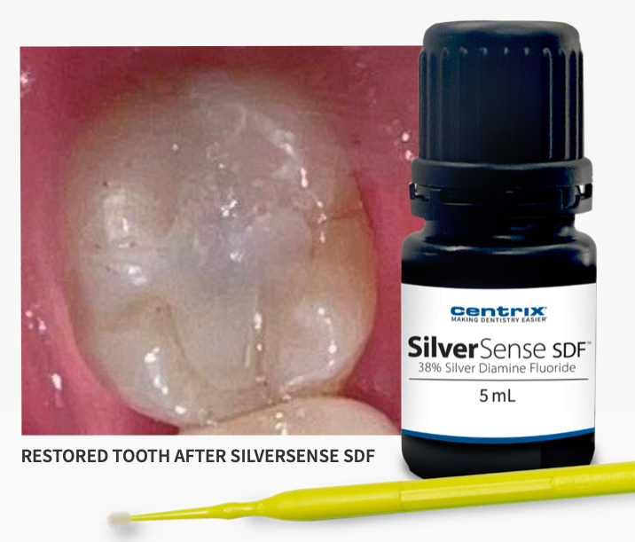 Adding Silver Diamine To Your Arsenal Of Options Atlanta Dental Adding Silver Diamine To Your Arsenal Of Options Atlanta Dental