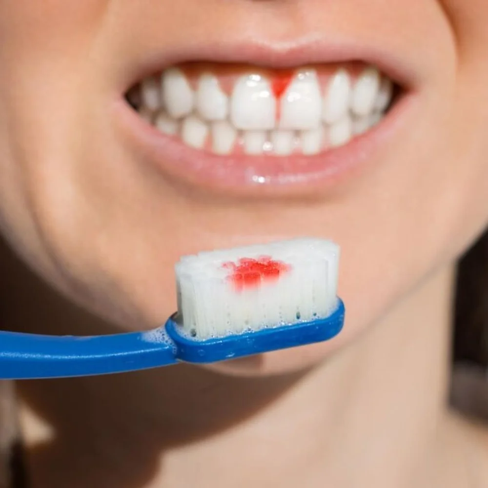 Common Causes of Bleeding Gums and How to Treat Them