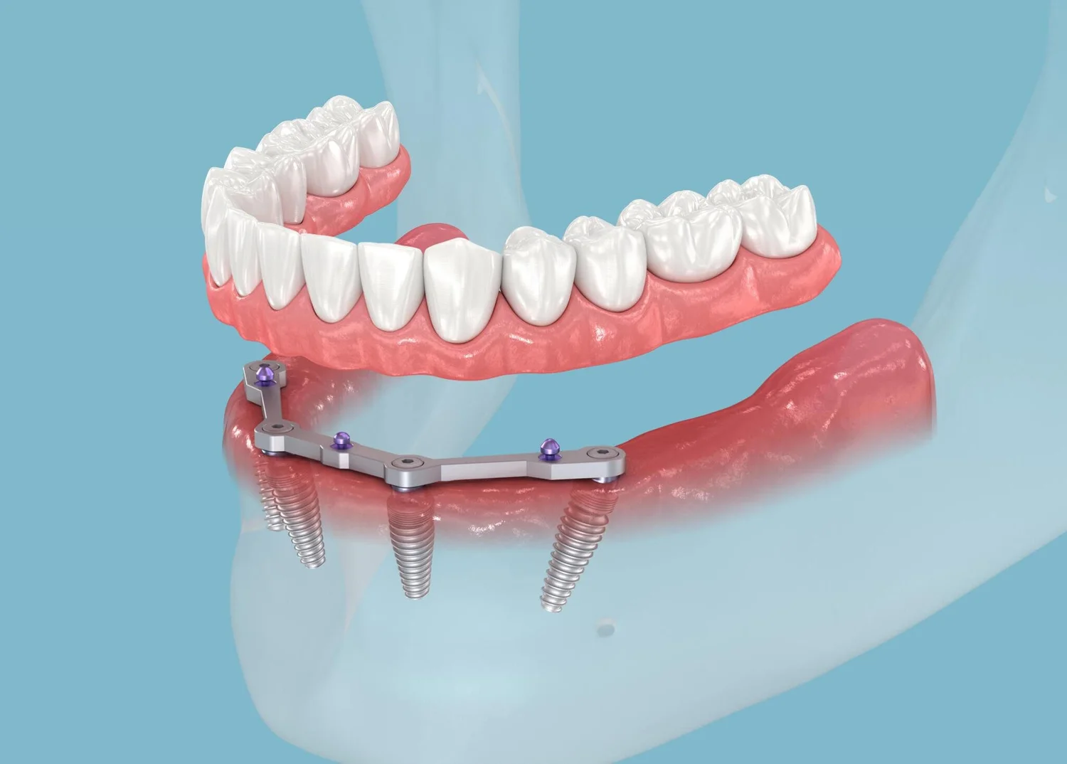 All-on-4 Dental Implants: Your Guide to a New Smile