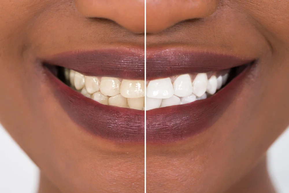 All About Teeth Whitening Procedure