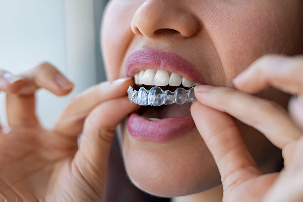 What Drinks Are Safe for Your Invisalign Aligners?