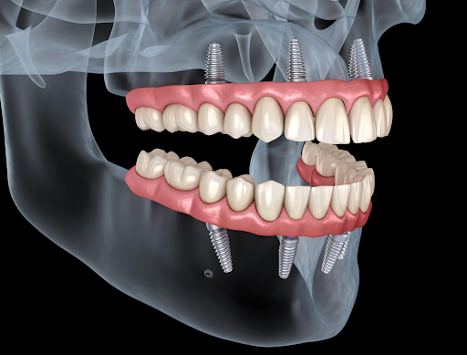 All-on-Four Implants: For Full Arch Restoration!