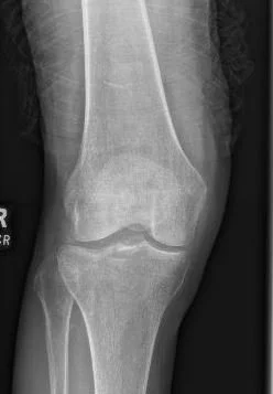 A 77 y.o. woman with a hx of stage III squamous cell cancer of the lung ...