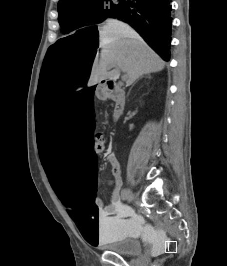 An elderly patient on peritoneal dialysis with abdominal pain ...
