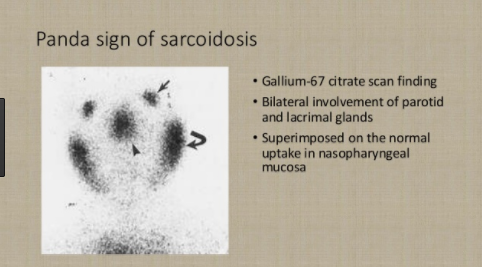 A 70 y.o. man presents with a one day history of bilateral parotid ...