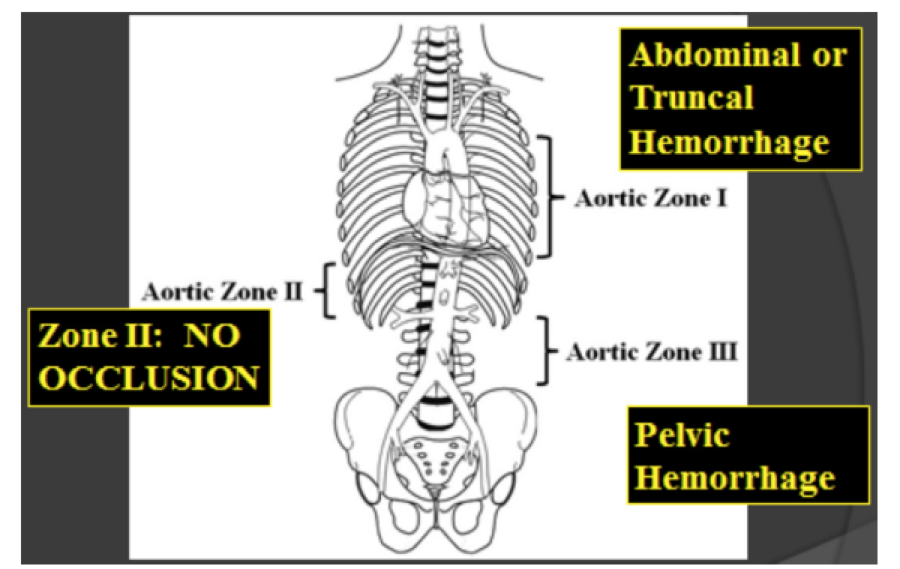 REBOA: Resuscitative Endovascular Balloon Occlusion of the Aorta ...
