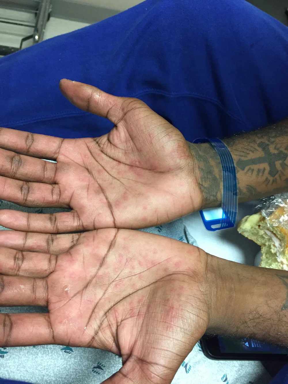 Toxic Shock Syndrome Rash On Palms