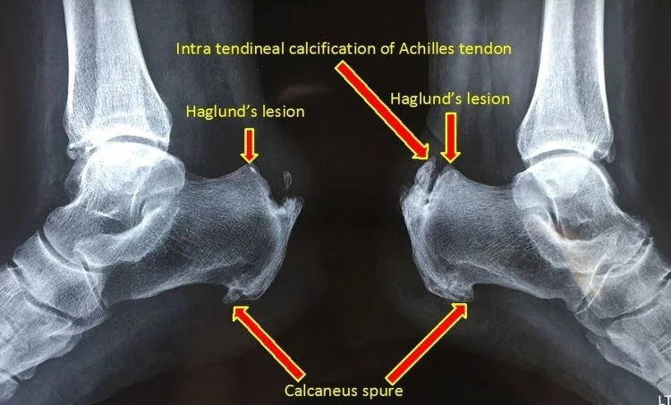 A 31 y.o. male comes in with bilateral heel pain. His xray is shown ...