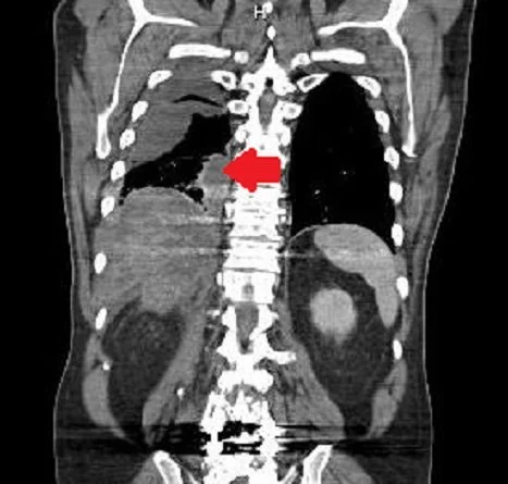 A 61 y.o. male presents with RUQ pain, he is sp cholecystectomy 10/2022 ...