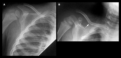 Clavicular Fractures — WashU EM Blog