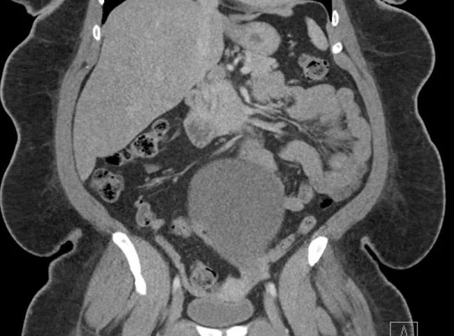 A 39 y.o. woman persents with peritonitis, she has a history of a ...