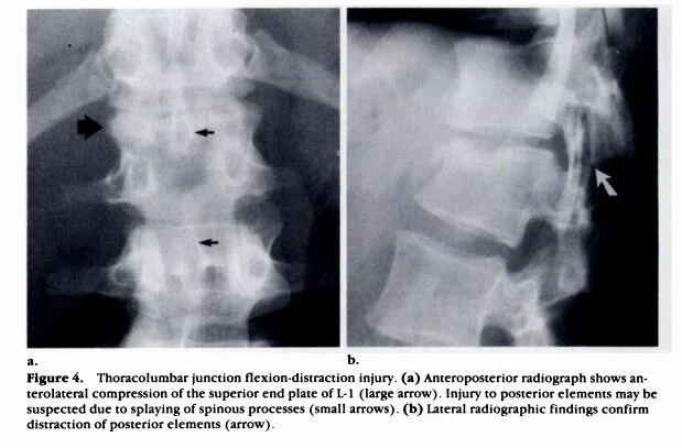 A 62 y.o. woman presents with chest pain after a roll over MVC ...