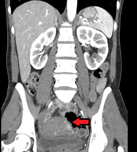 A 51 y.o. woman presents with L flank pain and pelvic pain. — Everyday ...