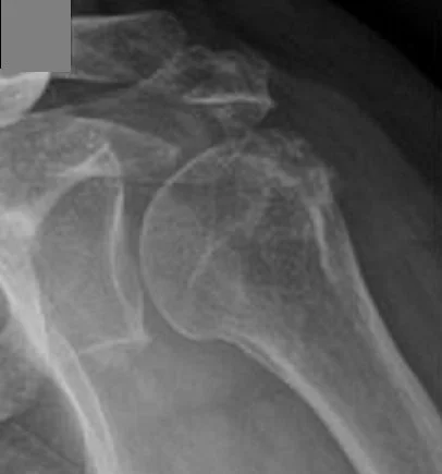 A 70 y.o. woman had the sudden onset of pain in the shoulder when ...