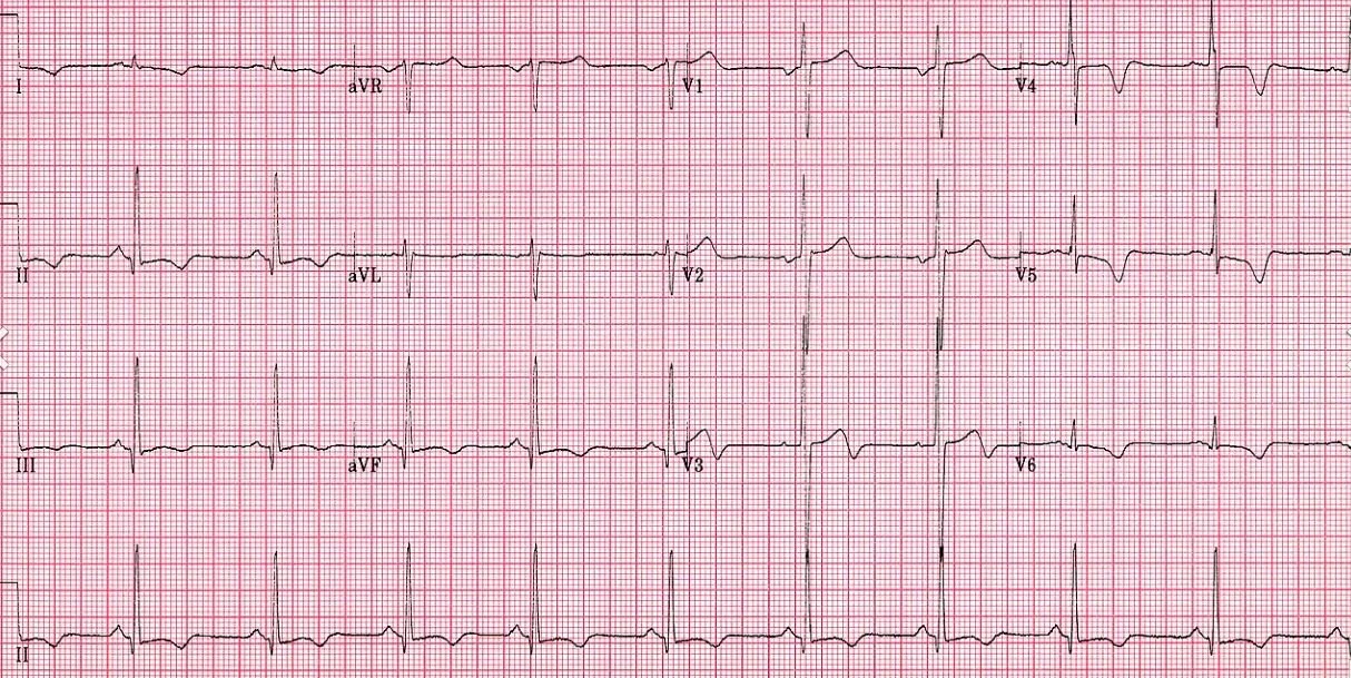 A 38 y.o. male with a long history of syncopal episodes; often after he ...