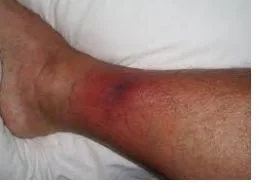 An 84 y.o. male noted redness and weeping of the R leg for several ...
