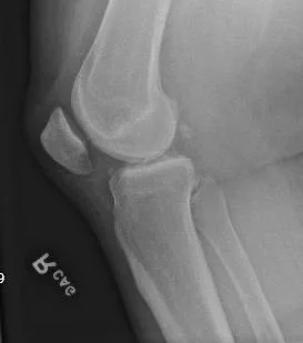 A 44 y.o. male fell down a flight of stairs. He landed on the L knee ...