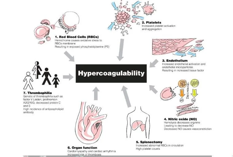 A 45 y.o. woman with lupus comes to the ED with R flank pain — WashU EM ...