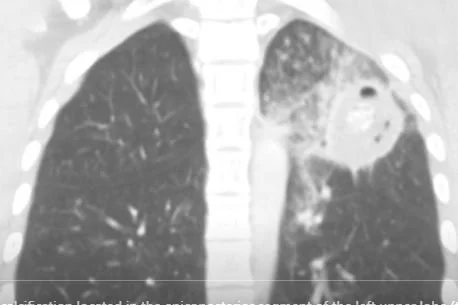 A 64 y.o. male from Mexico comes to the ED with shortness of breath ...