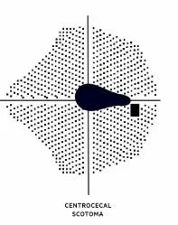 A 28 yo woman comes to the ED with a complaint of vision loss and ...