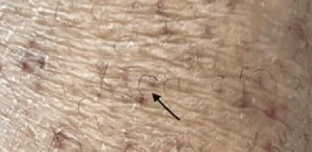 A 45 y.o. male with a history of gastric bypass comes in with a rash on ...