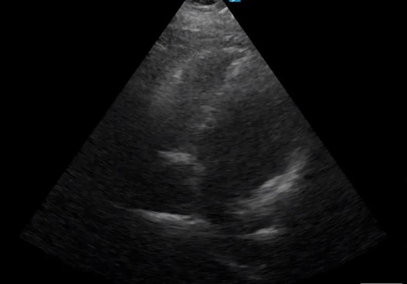 A 45 y.o. woman with lupus comes to the ED with R flank pain — WashU EM ...