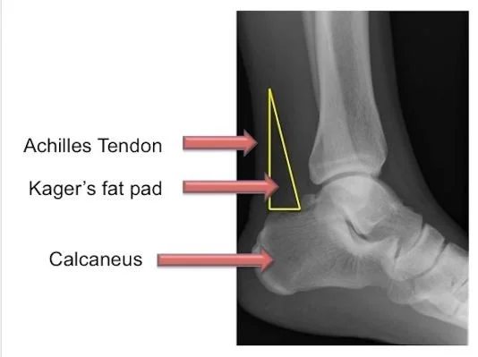 A 66 y.o. woman was hit in the back of the leg by a heavy hedge trimmer ...