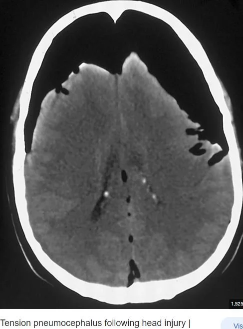 A 52 y.o. woman presents with altered mental status — WashU EM Blog
