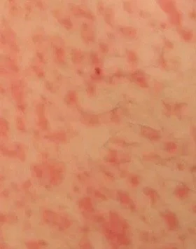 A 40 y.o. marathon runner in San Diego presents with a rash. — WashU EM ...