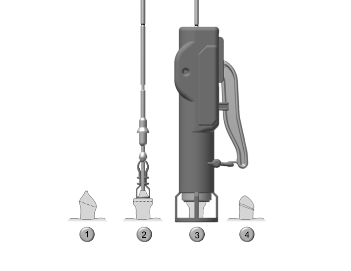 AccuCirc Device — SafeCirc Clinic