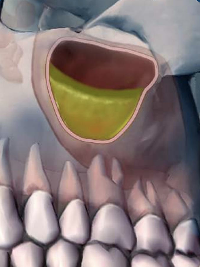 Maxillary Sinusitis Of Endodontic Origin Nerness Endodontics Maxillary Sinusitis Of Endodontic Origin Nerness Endodontics