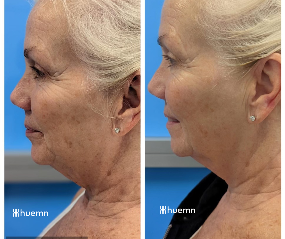 Houston Cryo Lift Facial | Huemn