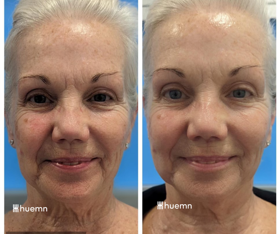 Houston Cryo Lift Facial | Huemn
