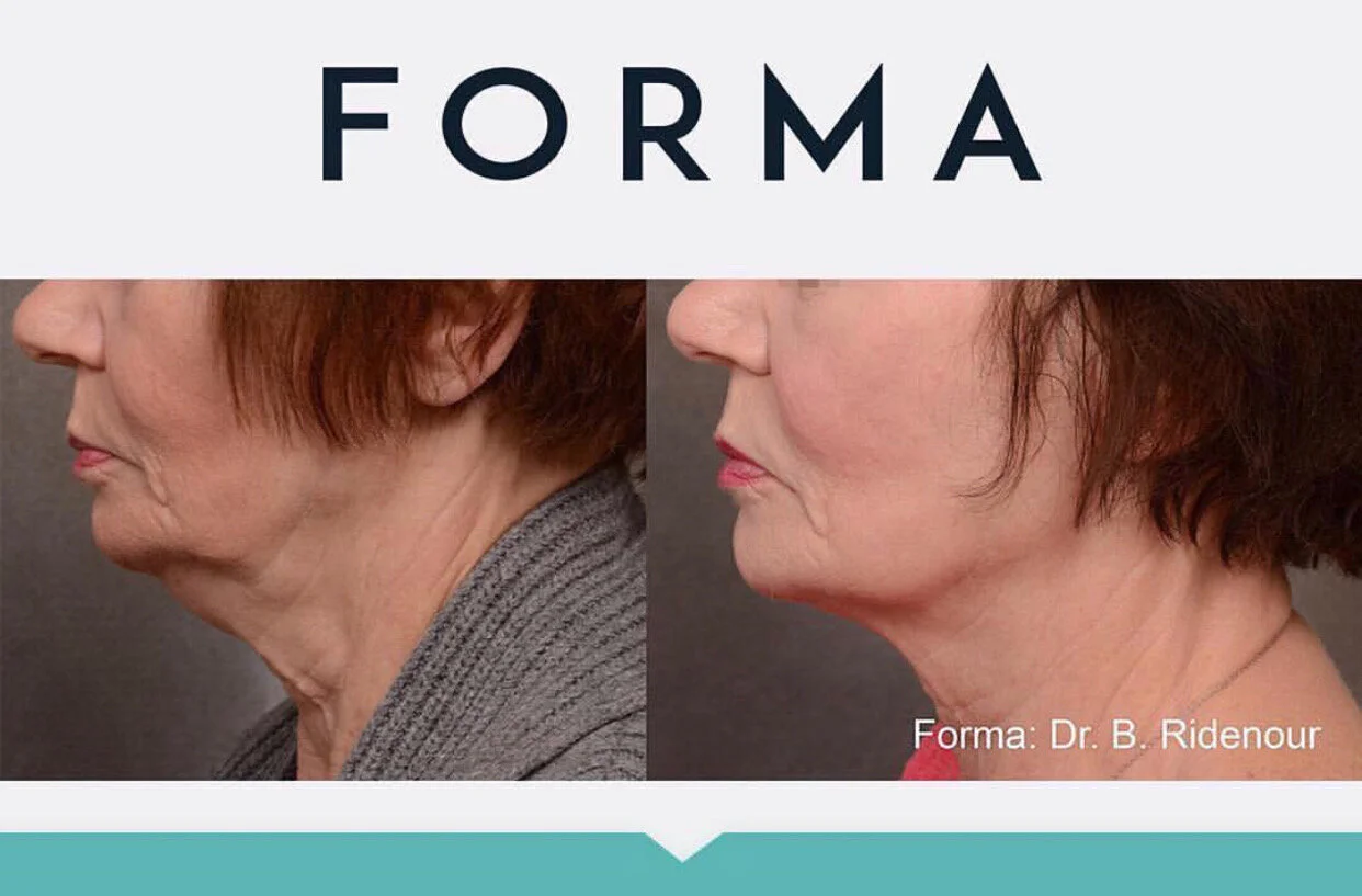 Forma Facial Toronto, Skin Tightening Toronto, Body FX , Forma Facial ...