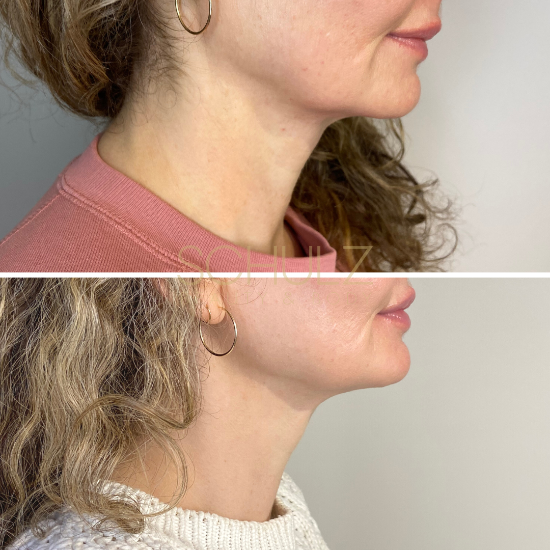 Forma Facial Toronto, Skin Tightening Toronto, Body FX , Forma Facial ...