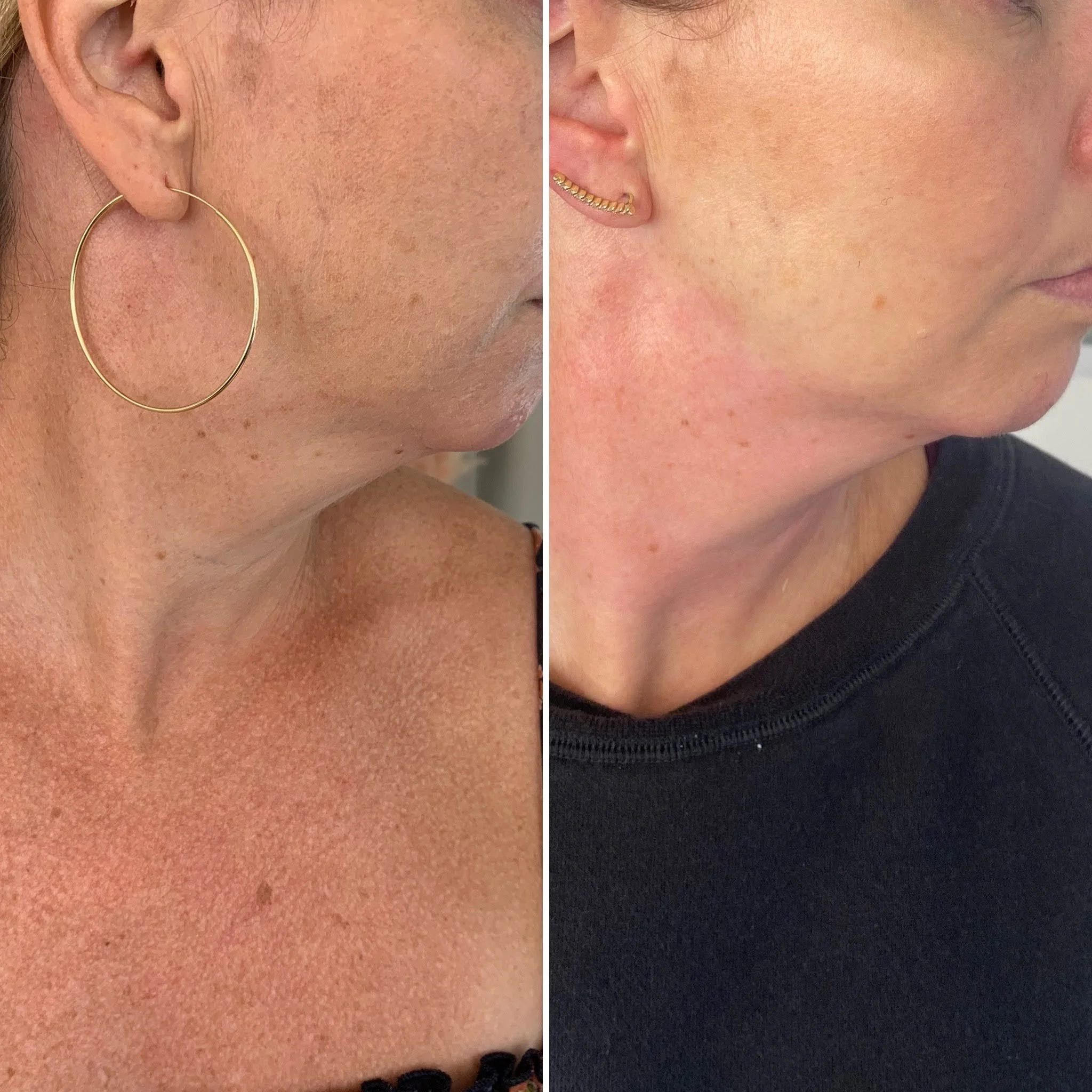 Forma Facial Toronto, Skin Tightening Toronto, Body FX , Forma Facial ...