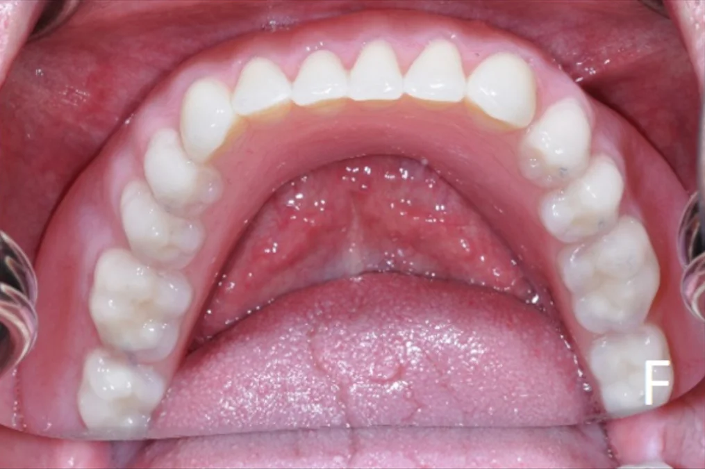 Upper and Lower - Case 3 — Puget Sound Periodontics | Thomas Kang DDS