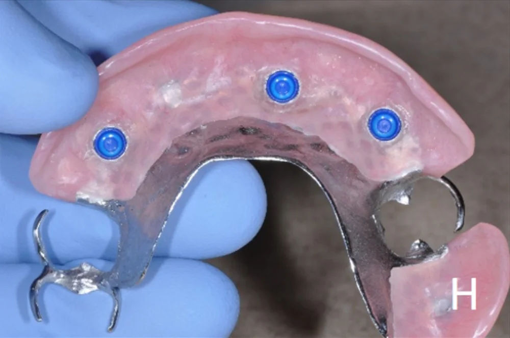 Upper and Lower - Case 3 — Puget Sound Periodontics | Thomas Kang DDS