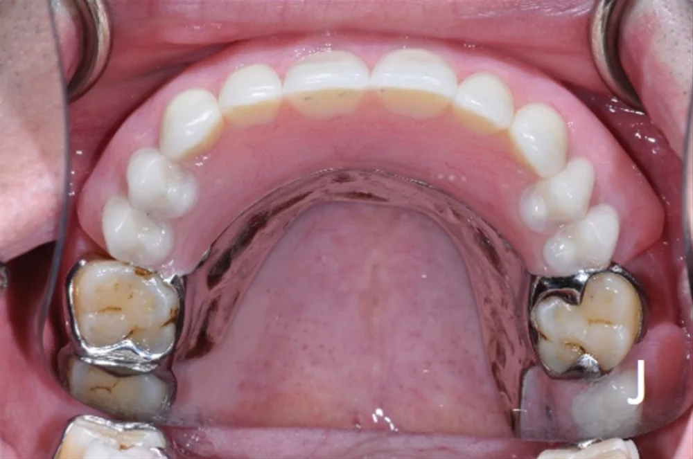 Upper and Lower - Case 3 — Puget Sound Periodontics | Thomas Kang DDS