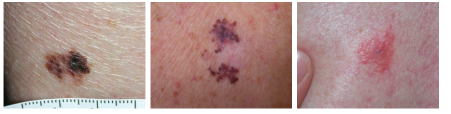 How to check for melanoma - BeautyEQ