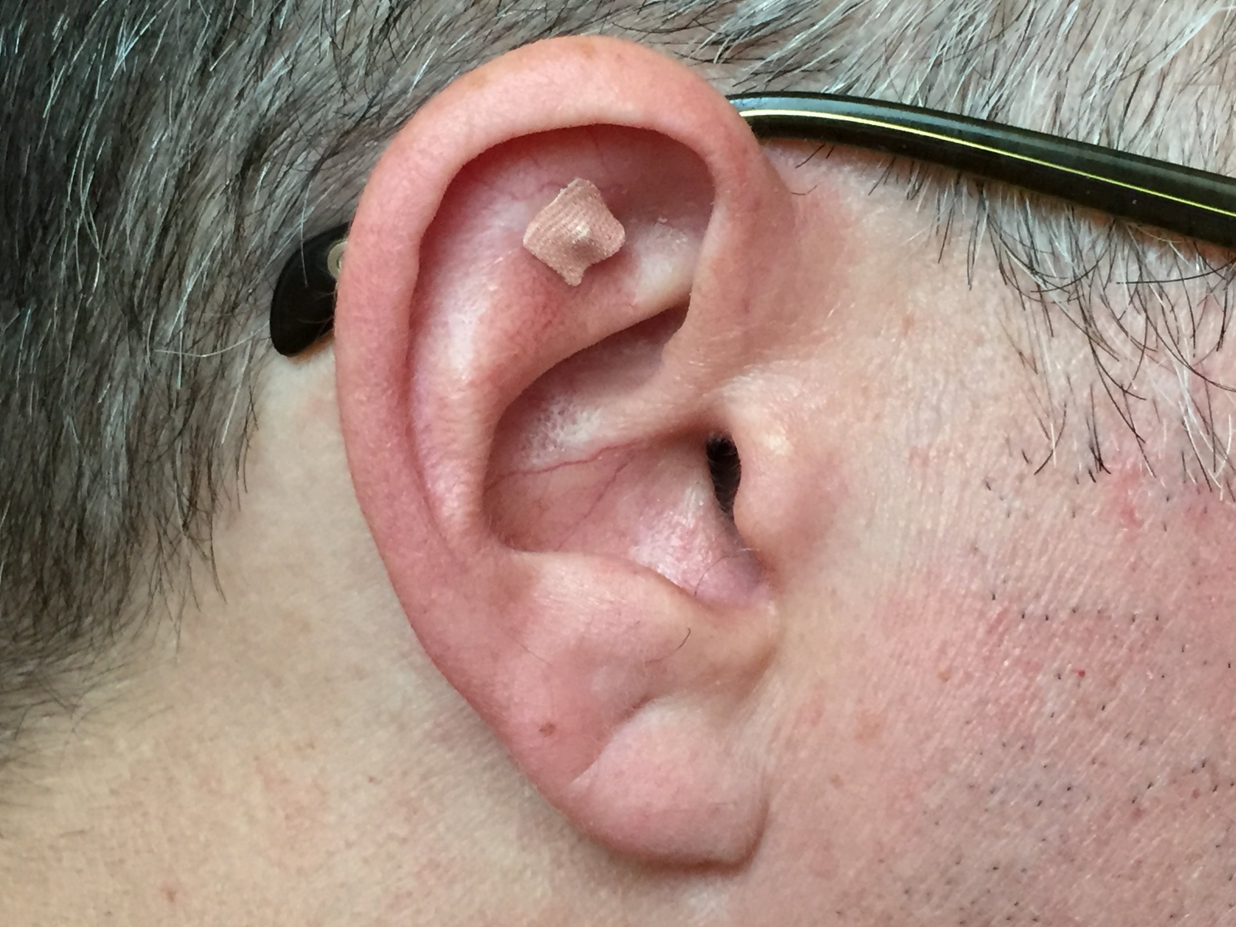 Put A Seed On It Earseeds And Needle Free Acupuncture Shawna Seth L
