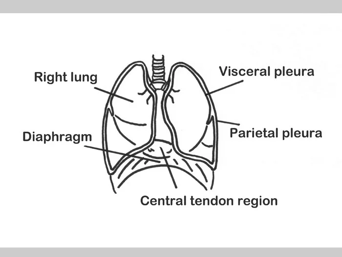 What is CPT? — Catamenial Pneumothorax