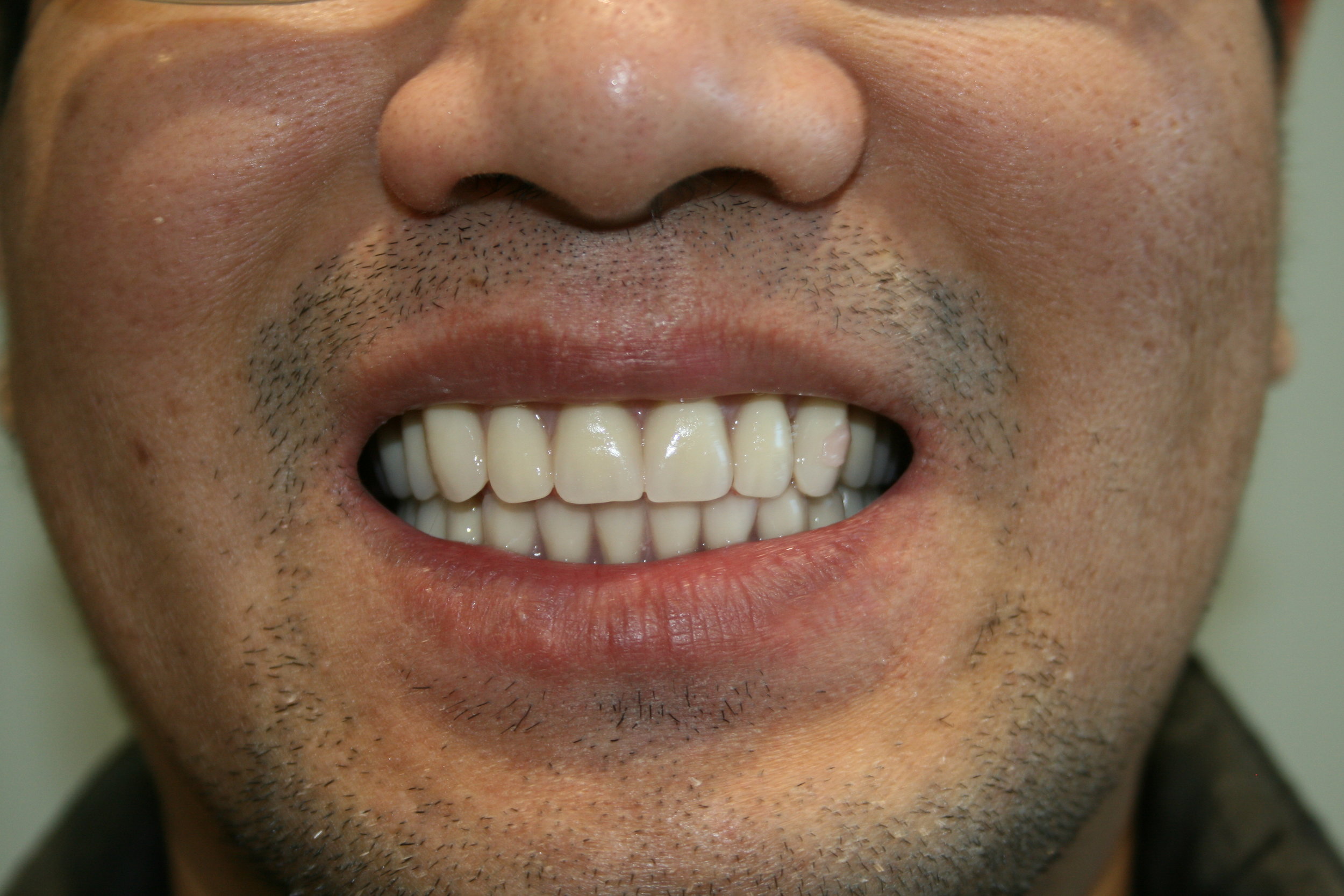 Surgical Dentures — Pearl Denture & Implant Centre